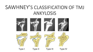 TMJ Ankylosis & It's Management | PPT