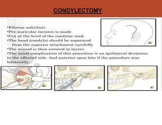 Temporomandibular joint ankylosis ppt presentation | PDF