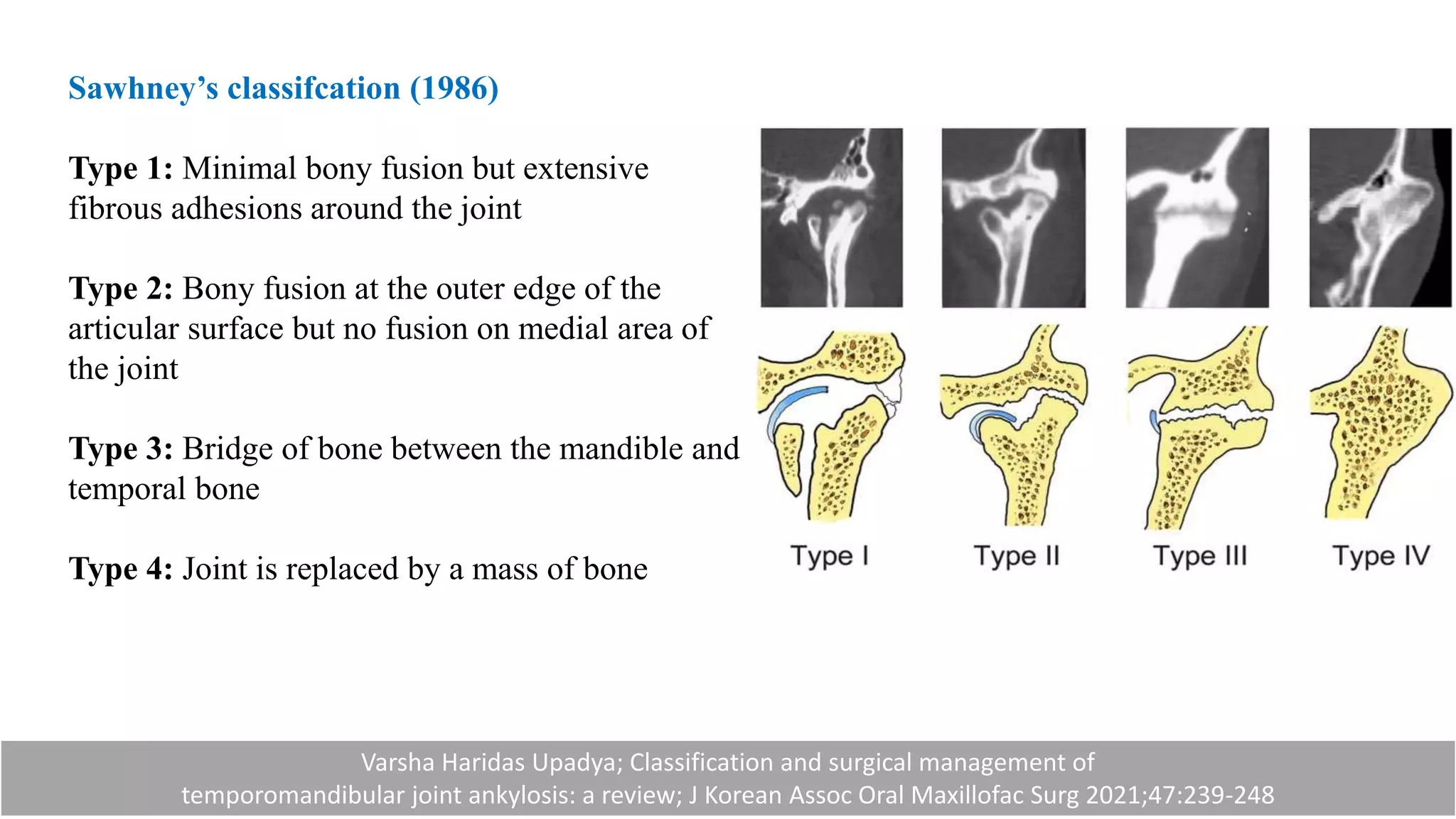 TMJ ankylosis and reconstruction.pptx