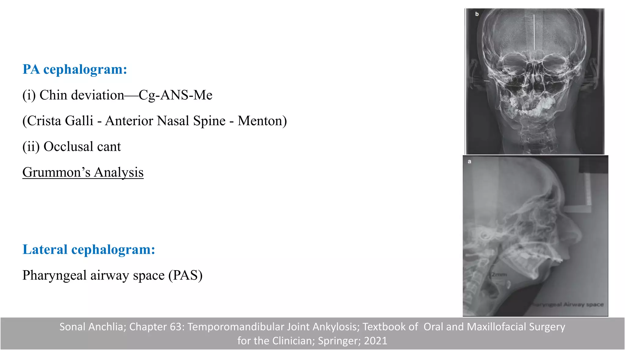 TMJ ankylosis and reconstruction.pptx