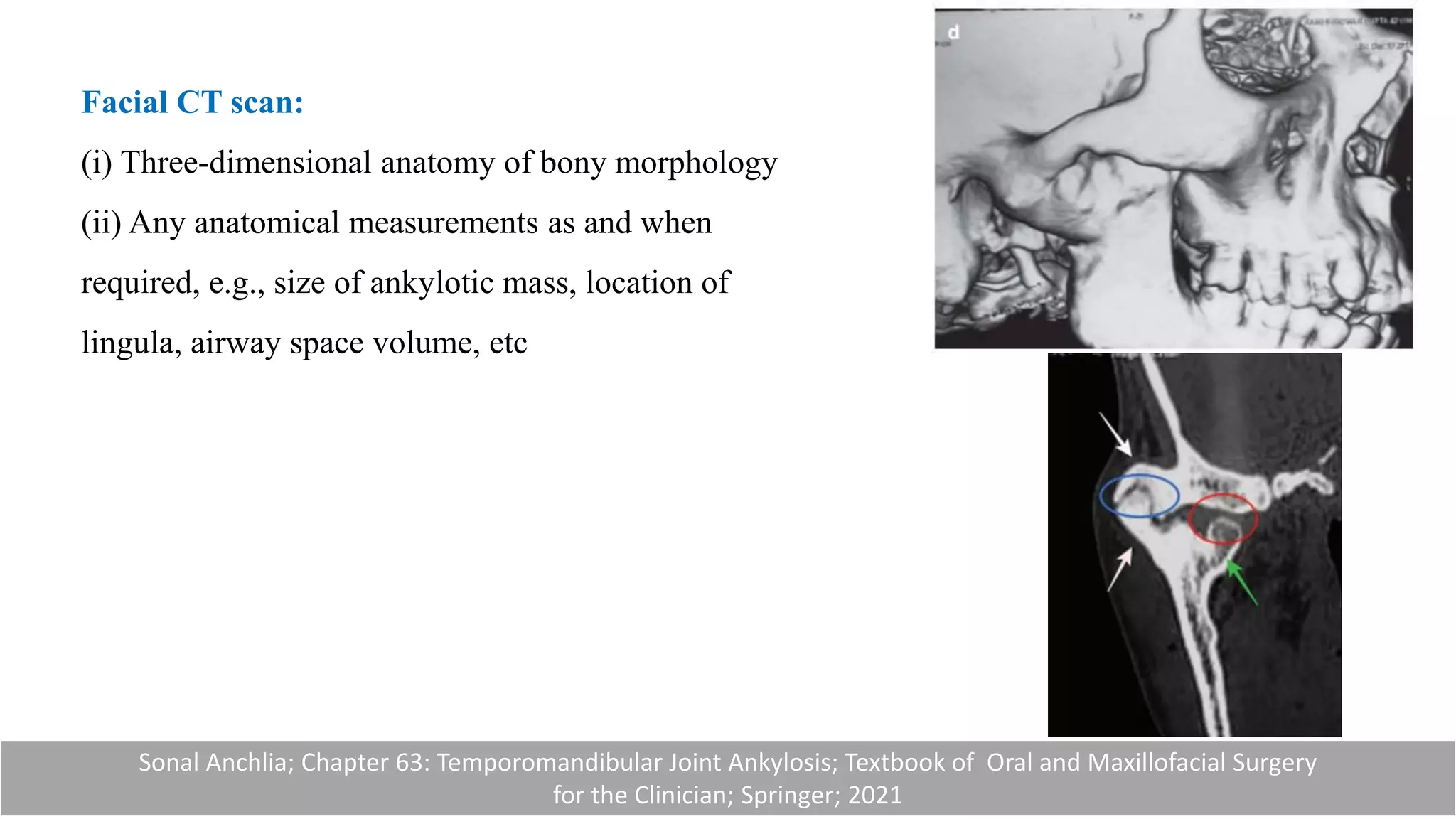 Tmj Ankylosis And Reconstructionpptx