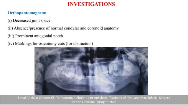TMJ ankylosis and reconstruction.pptx