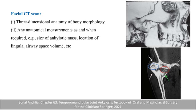 TMJ ankylosis and reconstruction.pptx