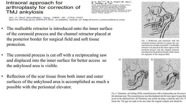 TMJ ankylosis and reconstruction.pptx