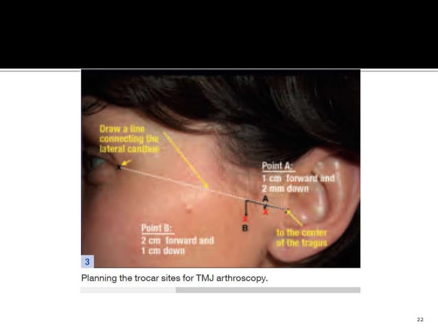 Tmj arthroscopy | PPT