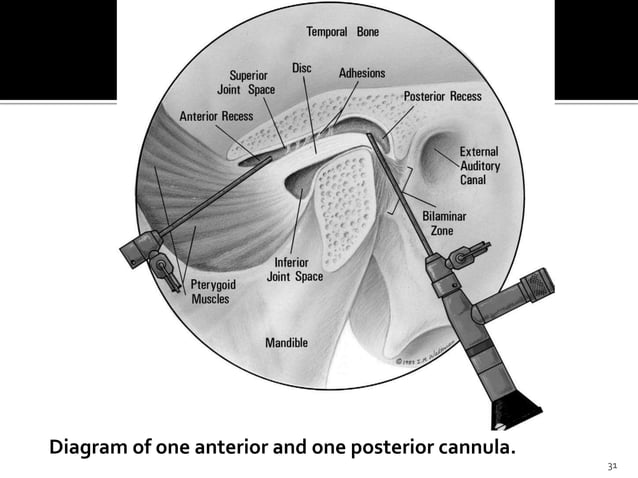 Tmj arthroscopy | PPT