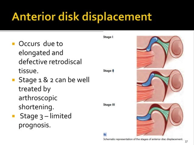 Tmj arthroscopy | PPT