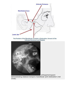 Tmj dislocation | DOC