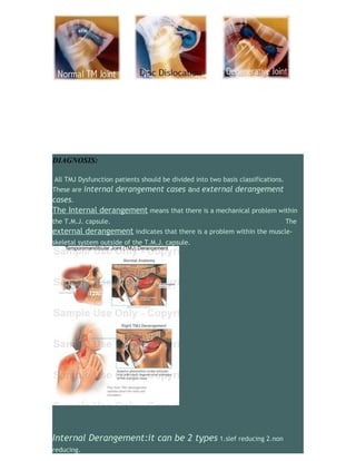 Tmj dislocation | DOC