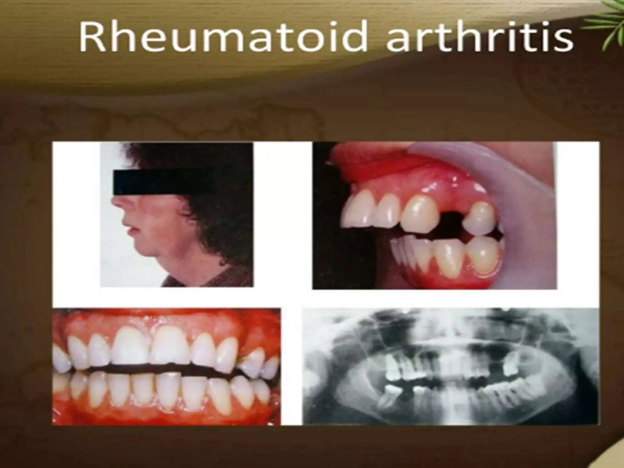 Clinical features,presentation,clinical and surgical management of TMJ ...