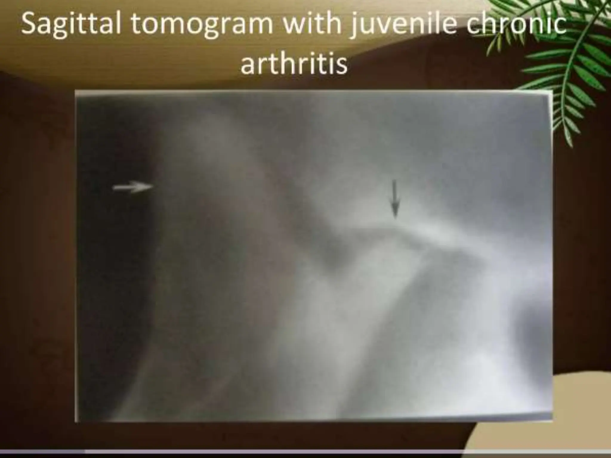 Clinical features,presentation,clinical and surgical management of TMJ ...