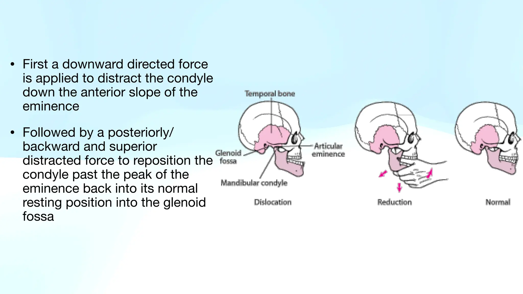 MANAGEMENT OF TEMPEROMANDIBULAR JOINT DISLOCATION | PPT