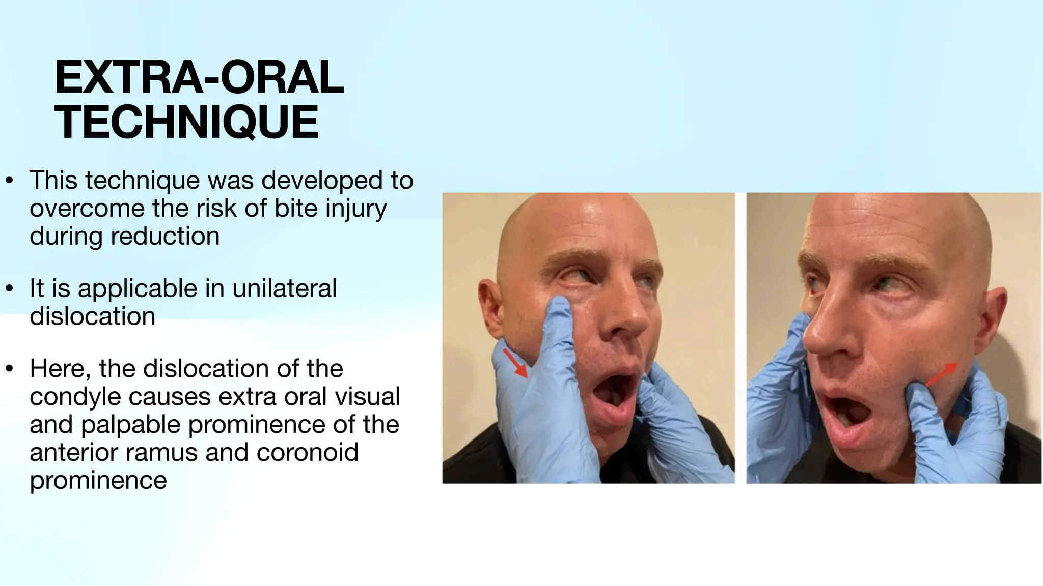 MANAGEMENT OF TEMPEROMANDIBULAR JOINT DISLOCATION | PDF