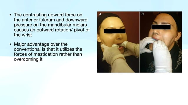 MANAGEMENT OF TEMPEROMANDIBULAR JOINT DISLOCATION | PPT