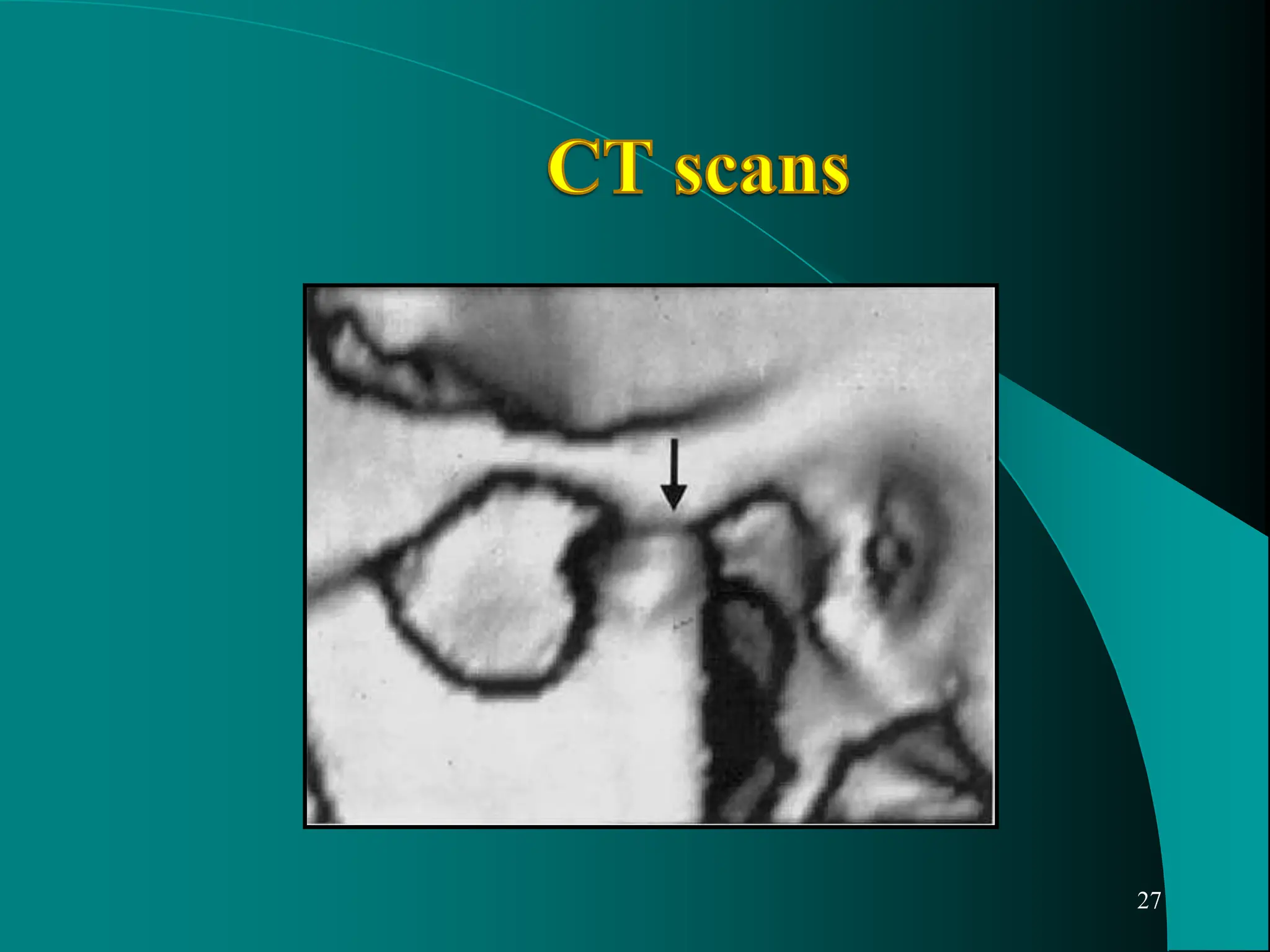 Tmj Dislocation And Its Management Pptx