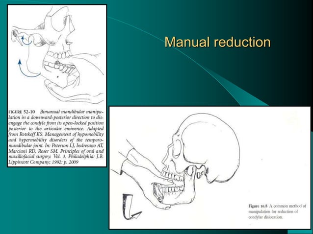 TMJ DISLOCATION AND ITS MANAGEMENT..pptx