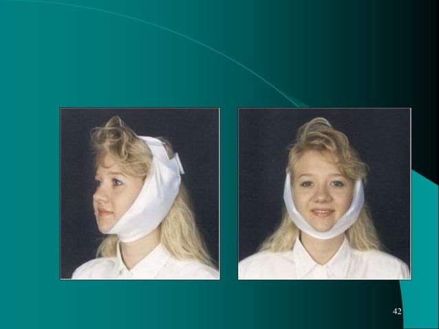 Tmj Dislocation And Its Management Pptx
