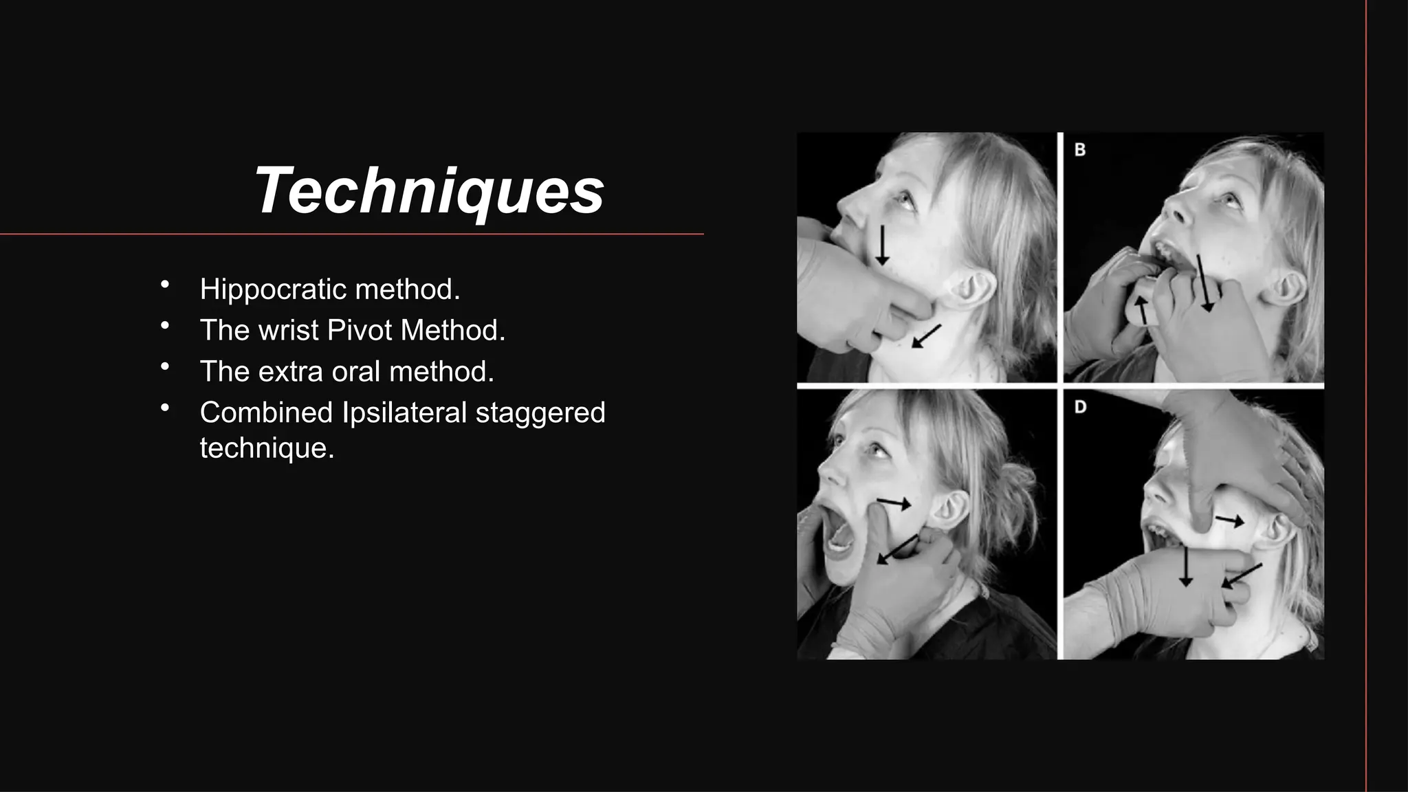 TMJ Dislocation for Anaestheologists final.pptx