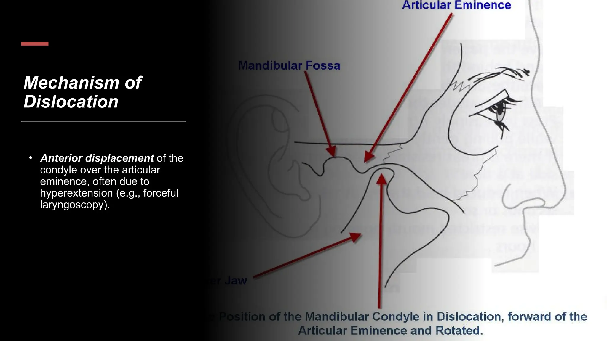 TMJ Dislocation for Anaestheologists final.pptx