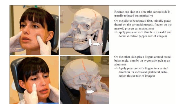 TMJ Dislocation for Anaestheologists final.pptx
