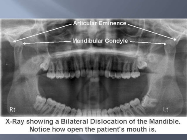 Tmj disorder | PPTX