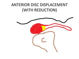 temporomandibular joint disorders | PPTX