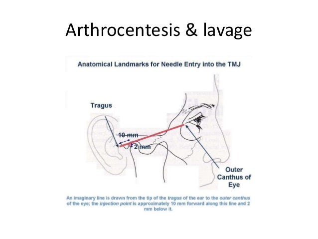 temporomandibular joint disorders