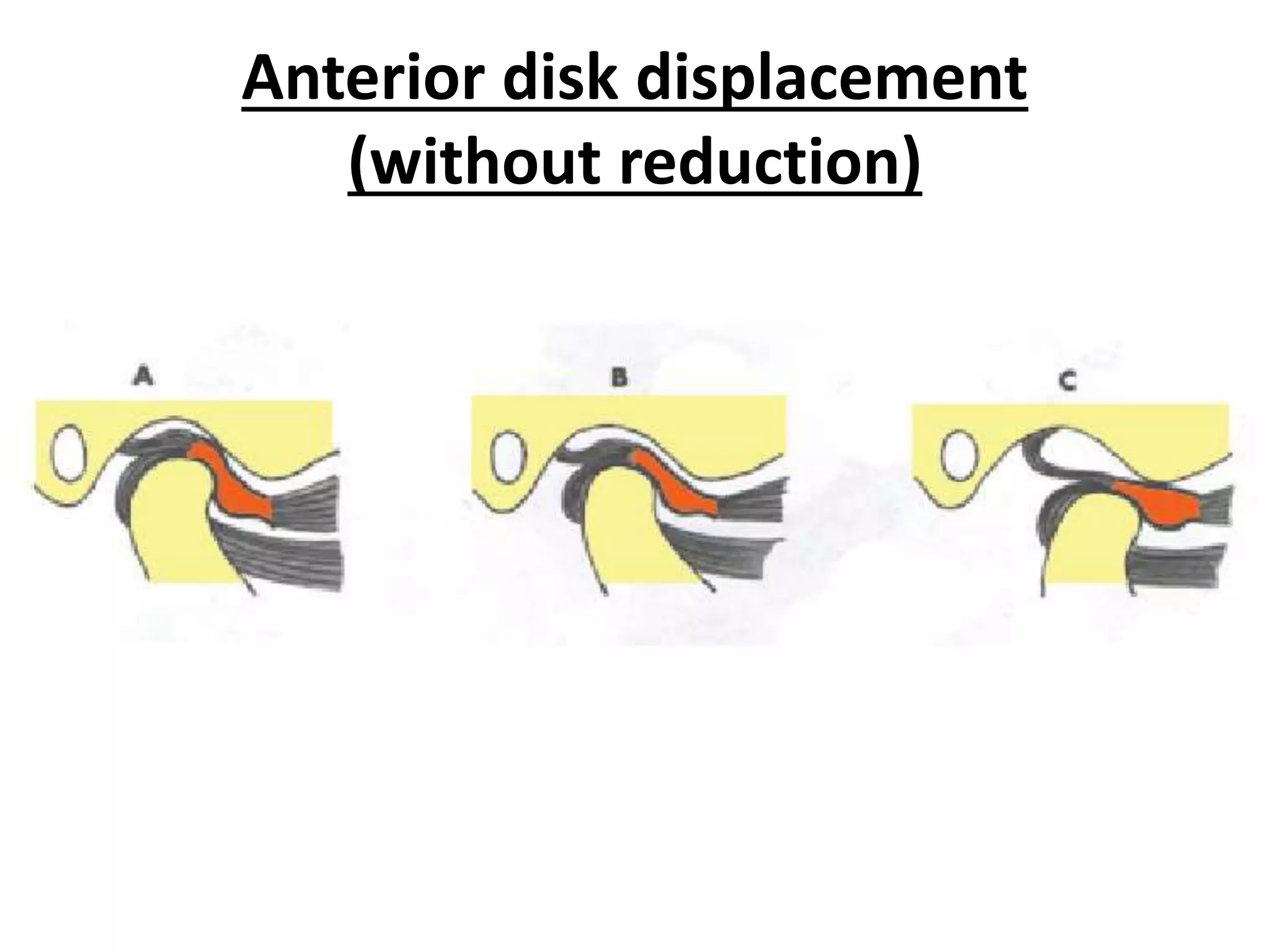 Tmj disorders | PPTX