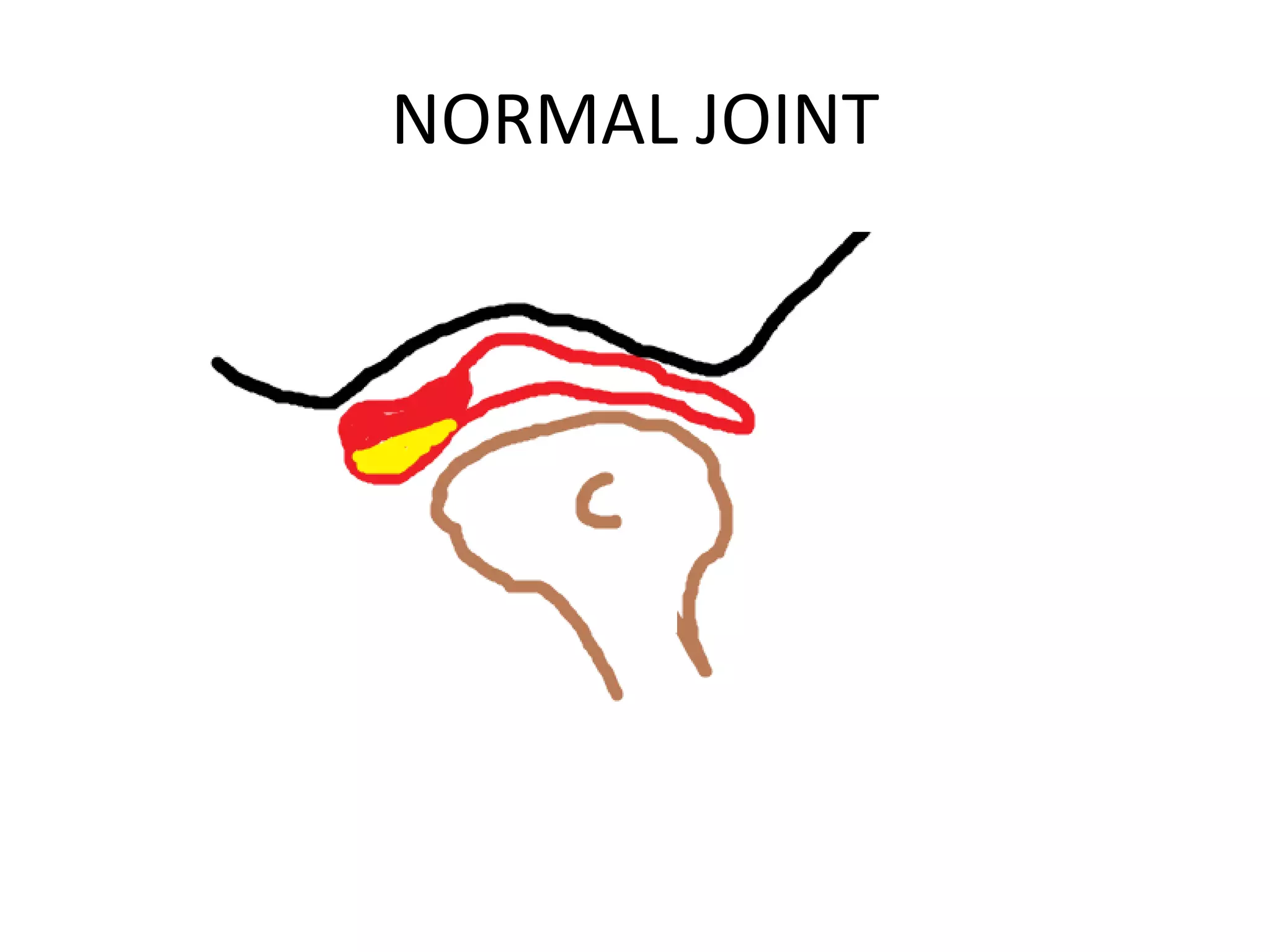 Tmj Disorders Ppt