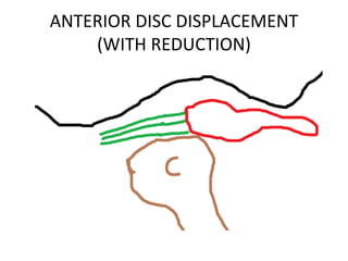 Tmj disorders | PPTX