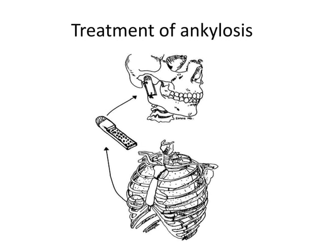 Tmj Disorders Ppt