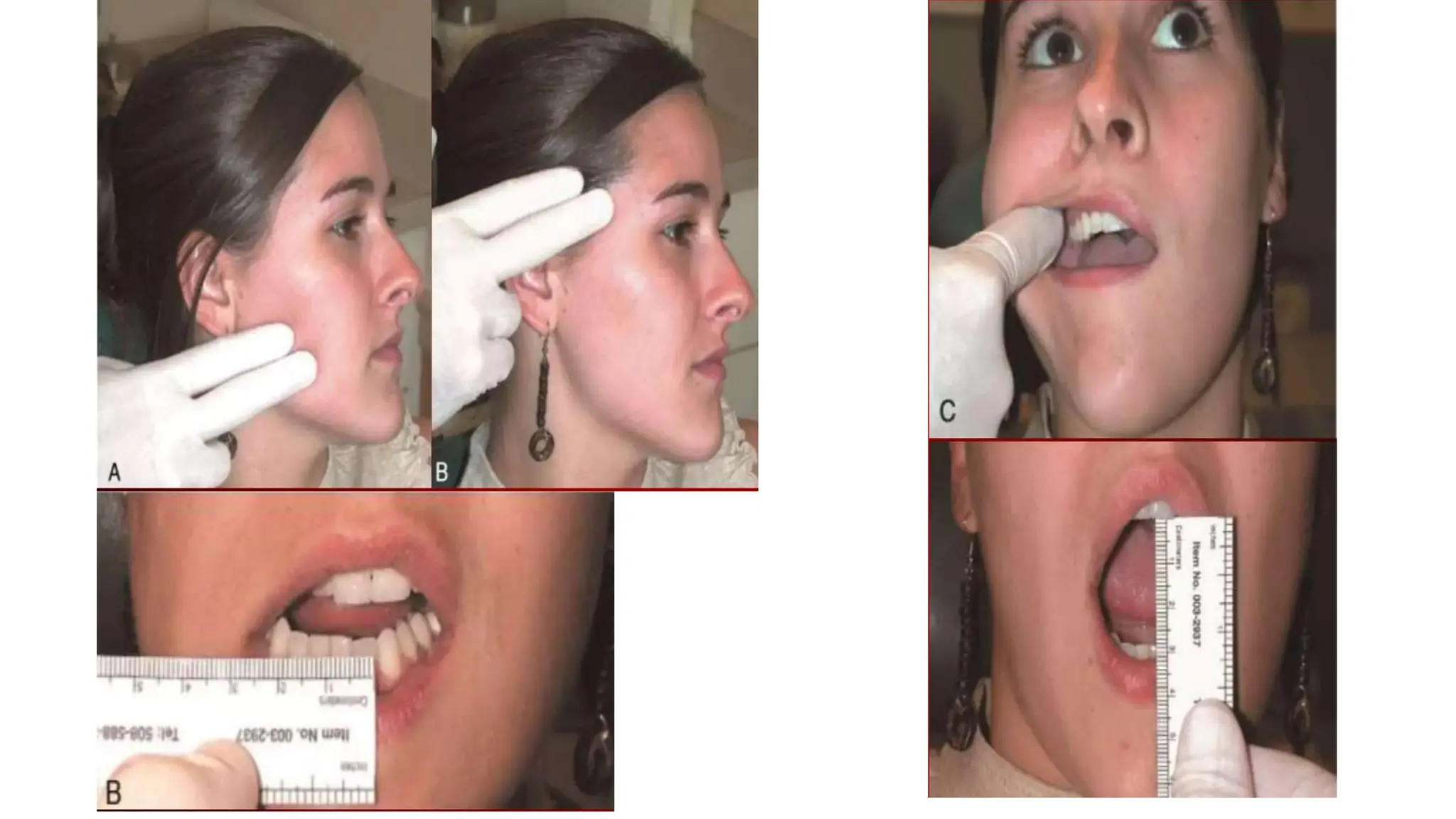 Disorders of the temporal mandibular joint | PPT