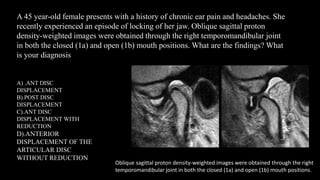 TEMPORO MANDIBULAR JOINT IMAGING PPT | PPTX