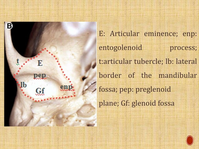 Tmj surgical anatomy and approaches | PPTX