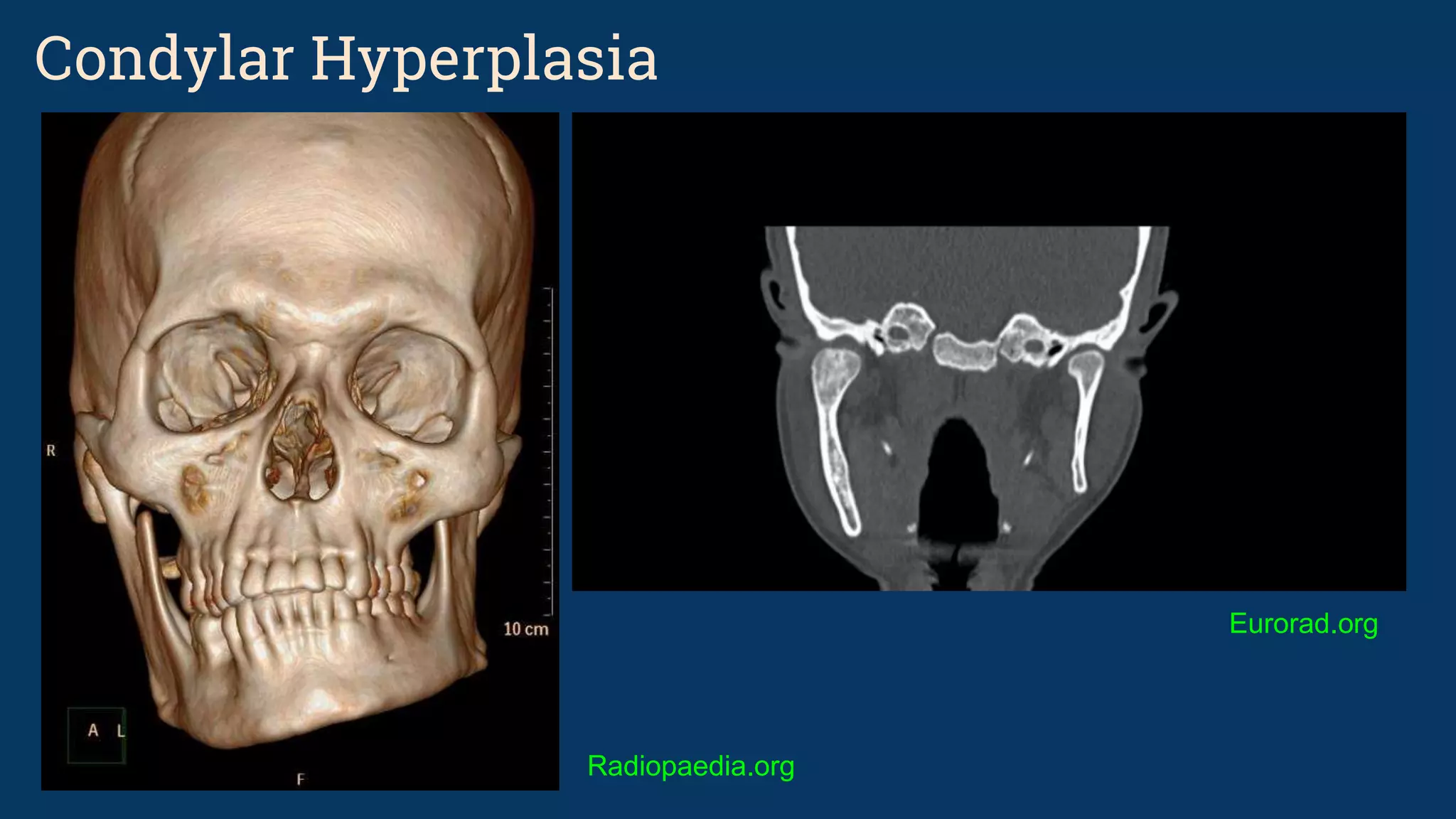 Tmj findings in cbct & mri | PPTX