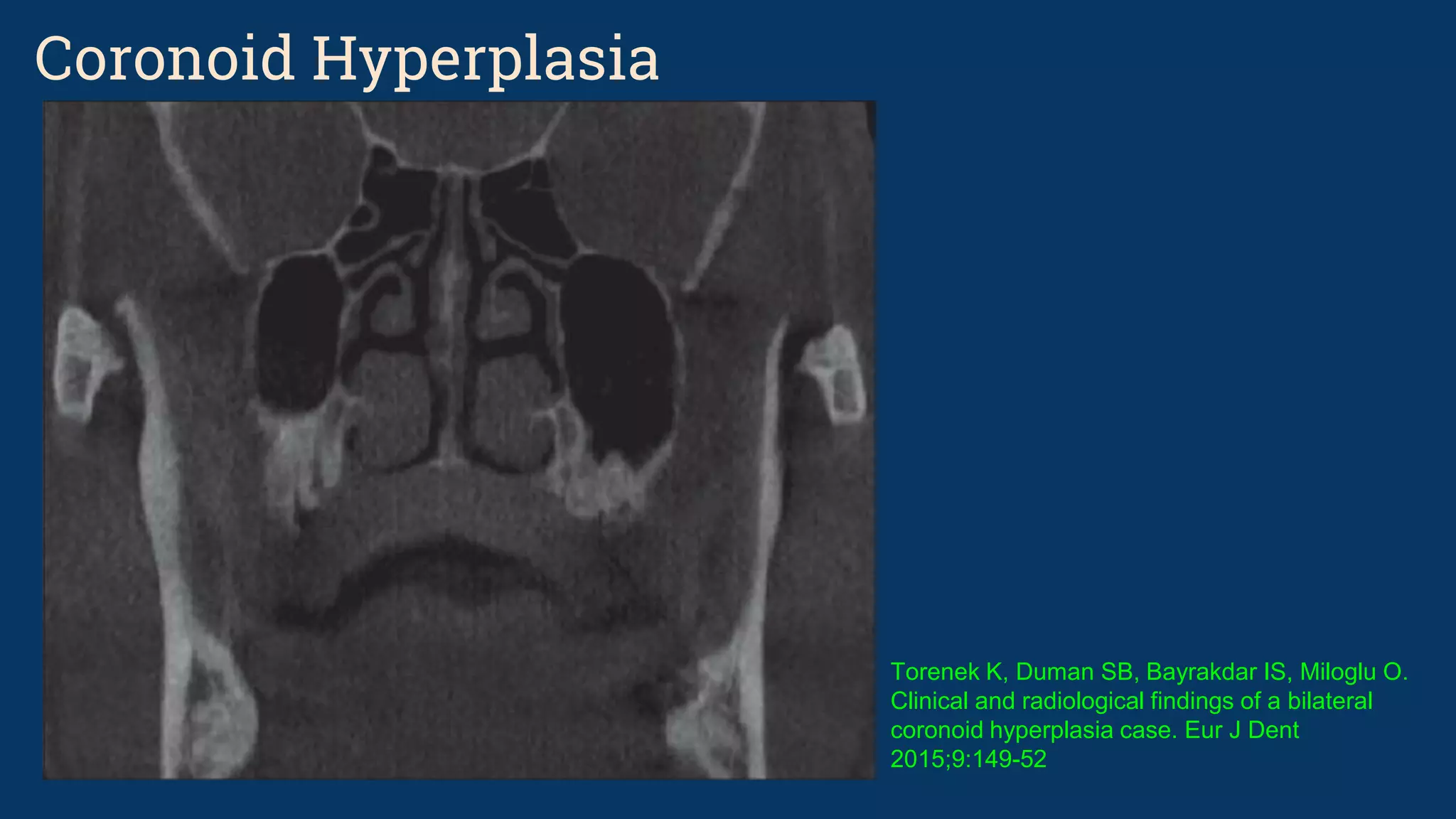 Tmj findings in cbct & mri | PPTX