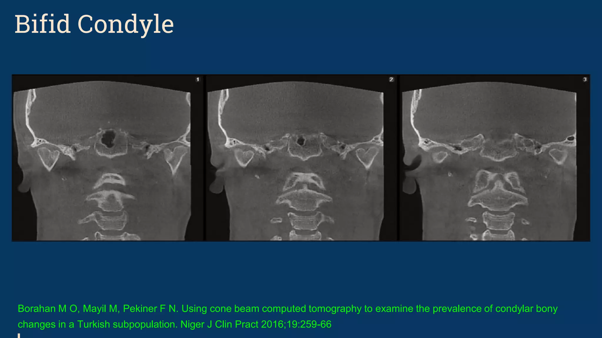 Tmj findings in cbct & mri | PPTX