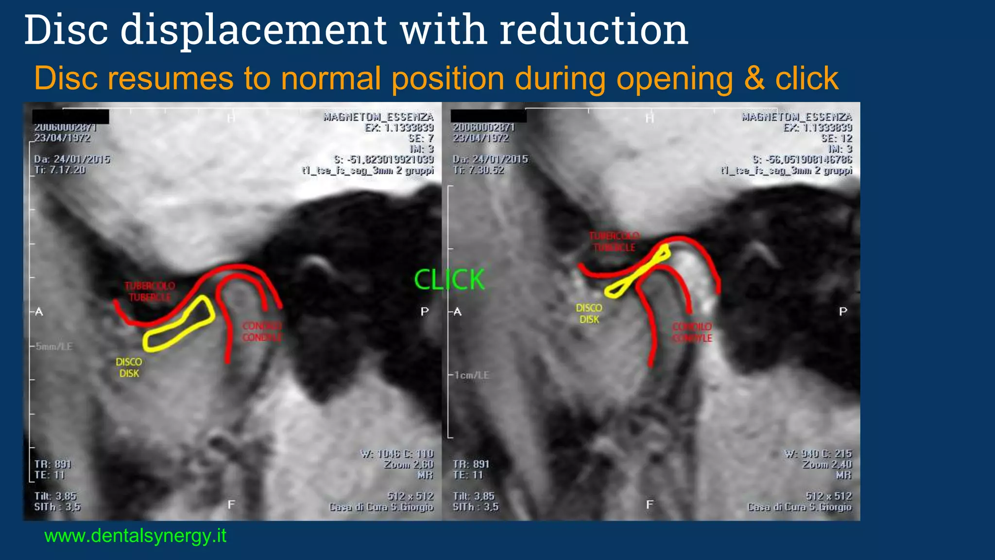 Tmj findings in cbct & mri | PPTX