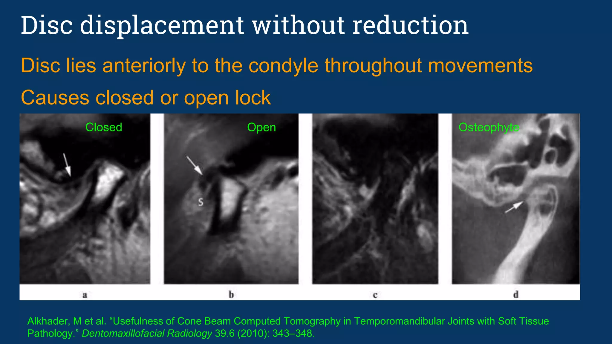 Tmj findings in cbct & mri | PPT