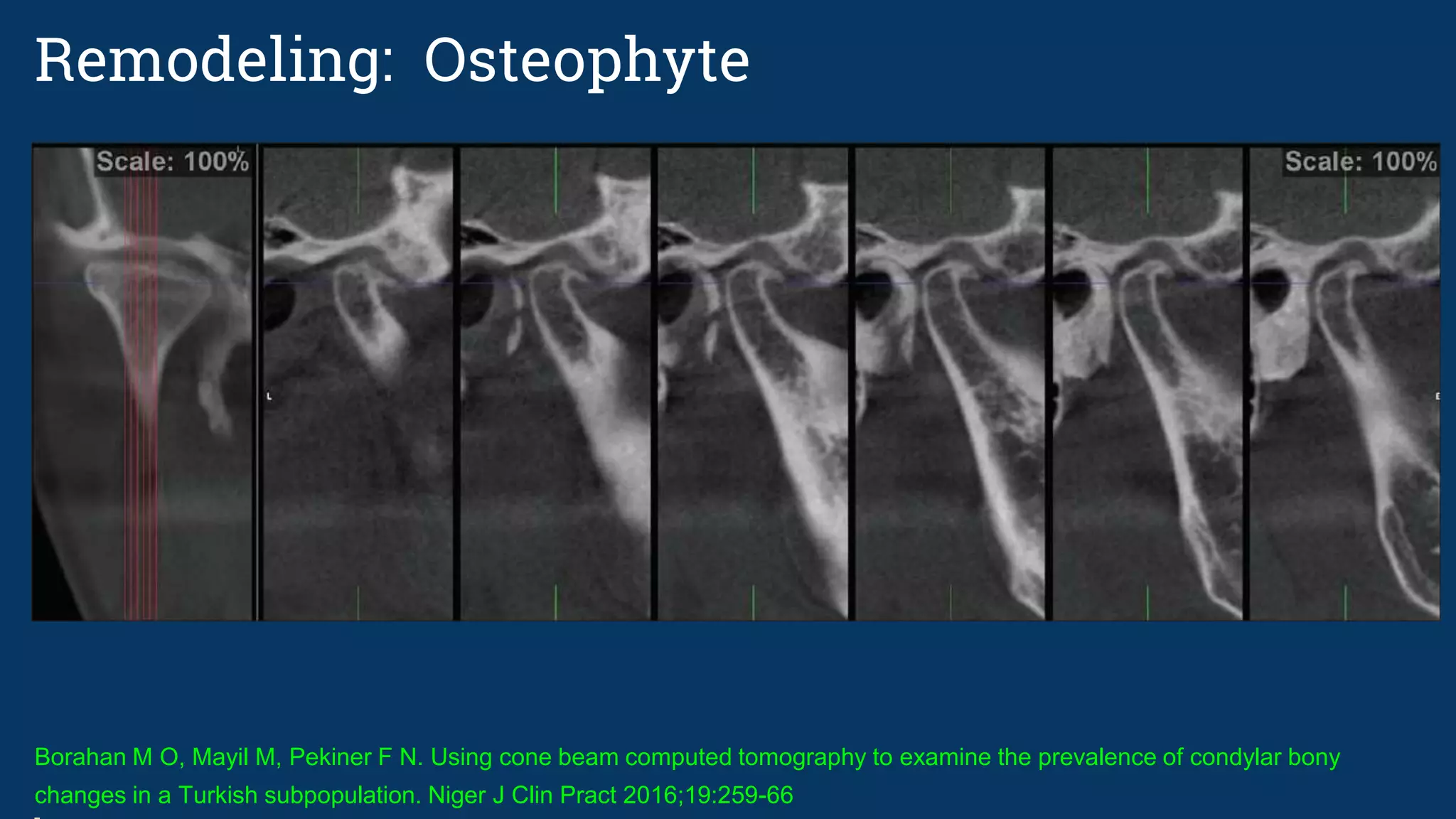Tmj findings in cbct & mri | PPTX | Bone and Joint Conditions ...