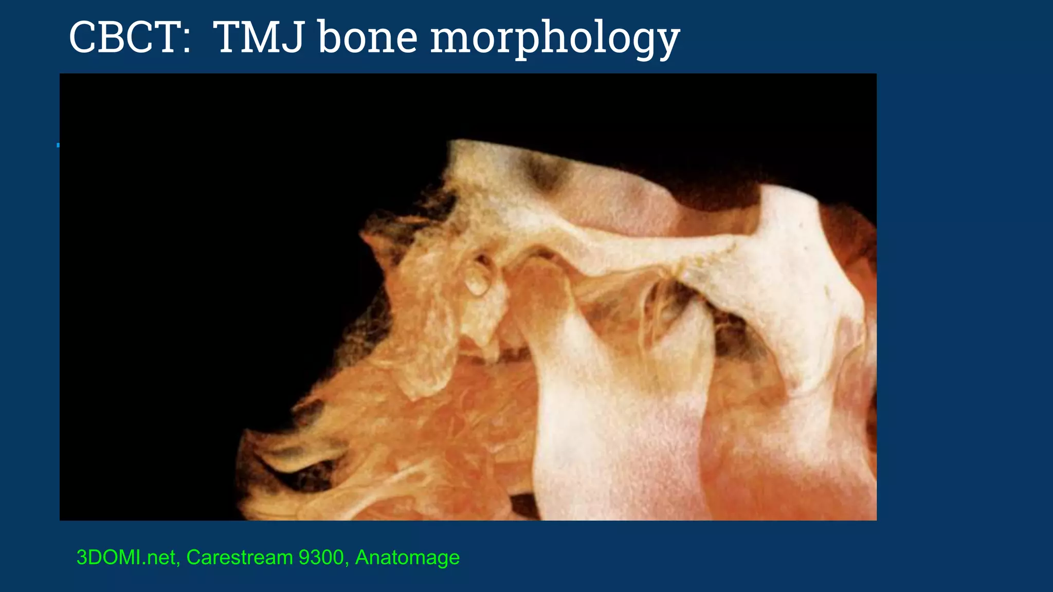 Tmj findings in cbct & mri | PPTX | Bone and Joint Conditions ...