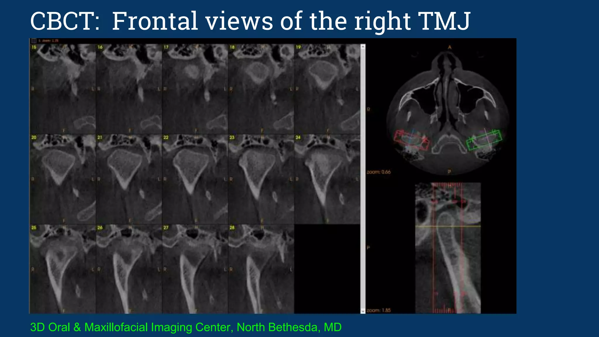 Tmj findings in cbct & mri | PPTX
