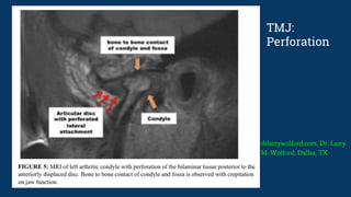 Tmj findings in cbct & mri | PPTX