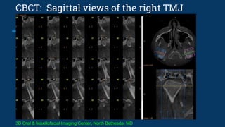 Tmj findings in cbct & mri | PPTX
