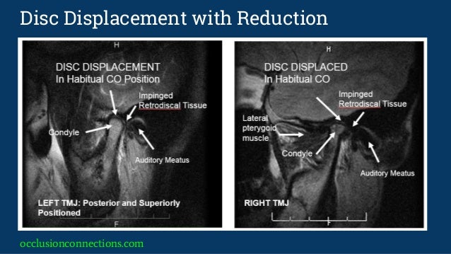 Tmj findings in cbct & mri