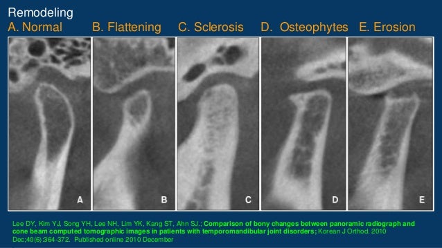 Tmj findings in cbct & mri