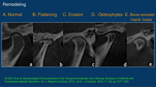 Tmj findings in cbct & mri