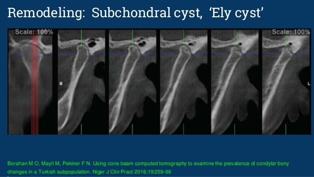 Tmj findings in cbct & mri