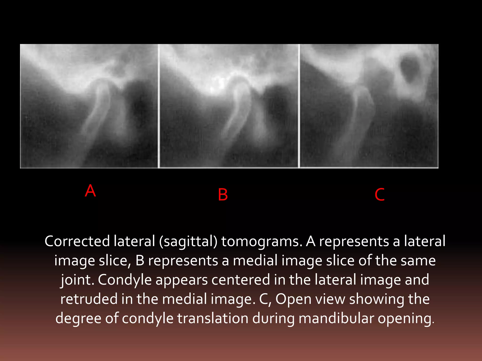 TMJ Imaging | PPTX | Bone and Joint Conditions | Diseases and Conditions