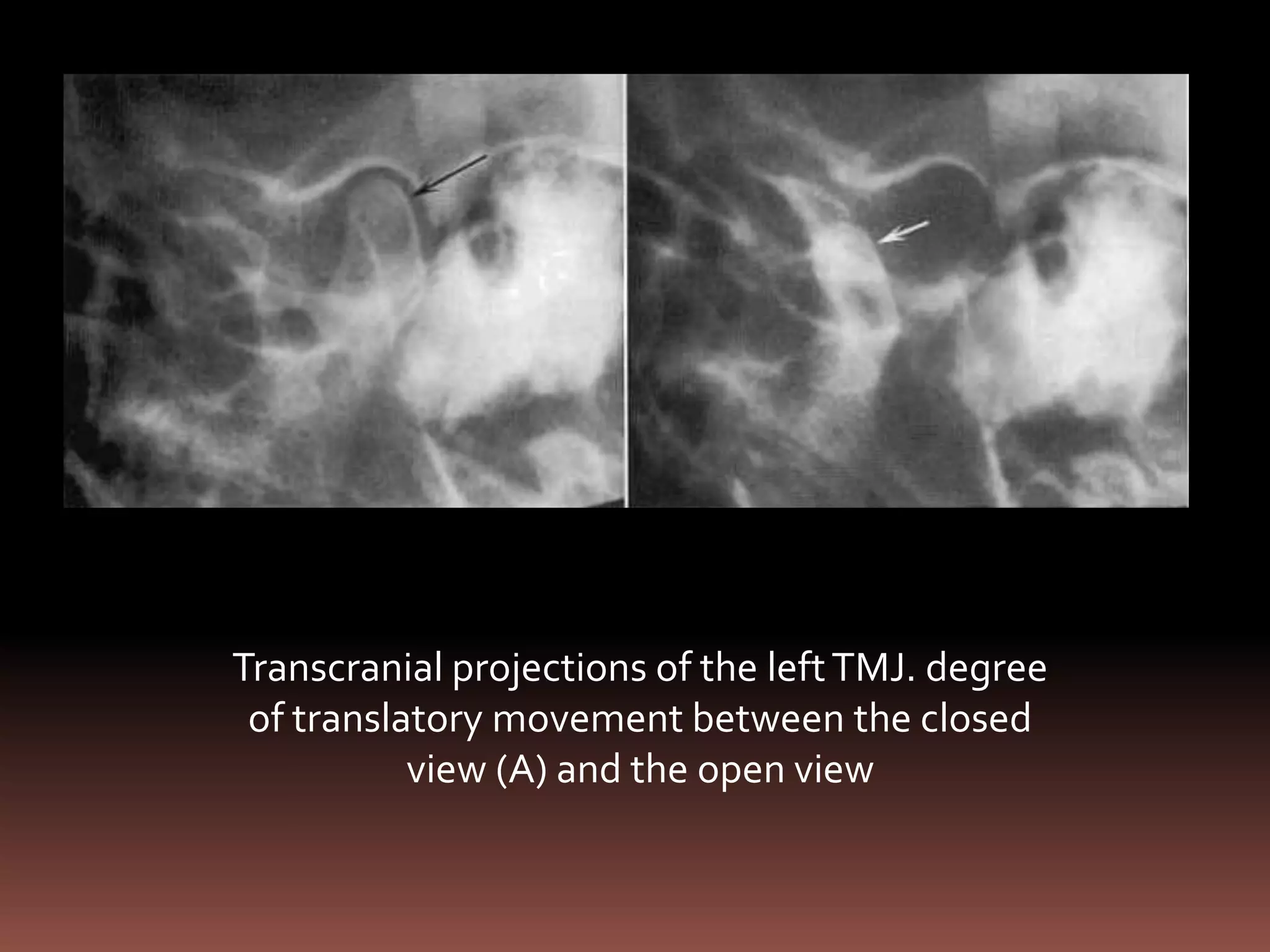 TMJ Imaging | PPTX